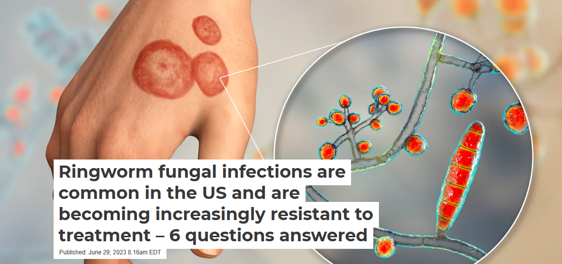 Ringworm fungal infections are common in the US and are becoming ...